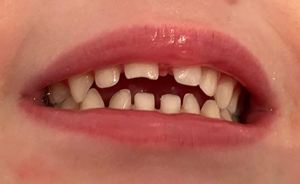 Avis Machouyou expérience et avant après, sevrage arrêt tétine pouce