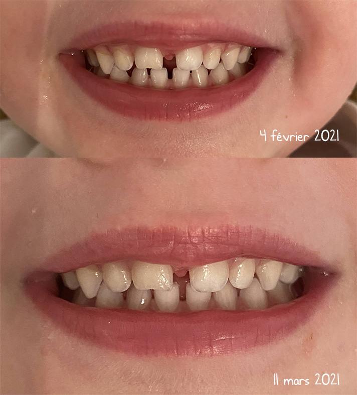 Avis Machouyou expérience et avant après, sevrage arrêt tétine pouce