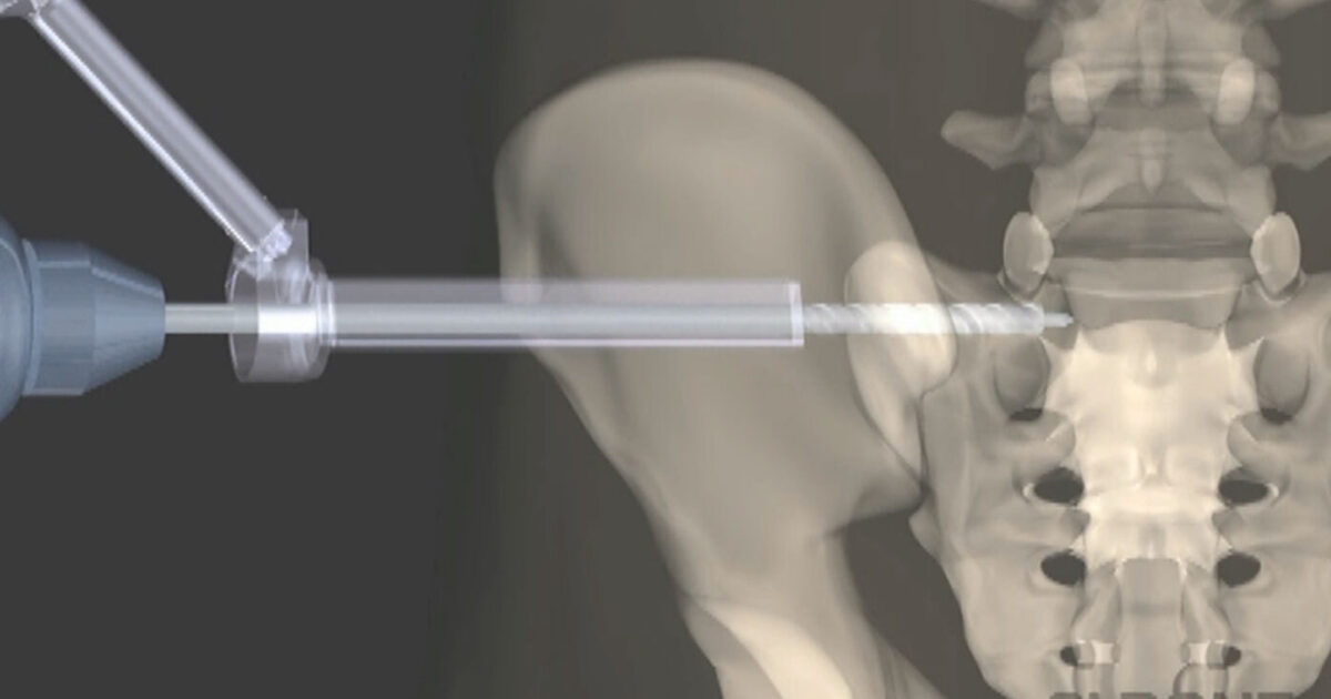 iFuse Navigation Technology | SI-BONE